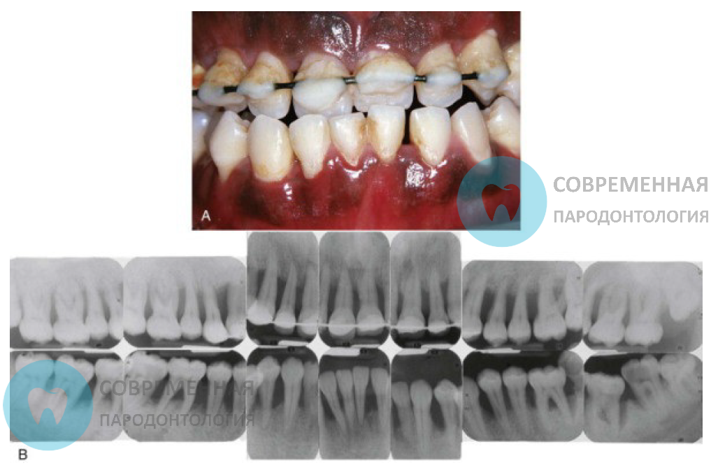 Агрессивный пародонтит - parodont.pro